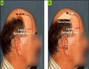 Principles of hair line : Importance of Hairline Design